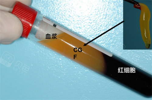 cgf种植牙新技术是个啥?是未来种植牙的新方向吗? - 贝色口腔