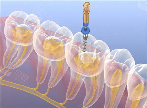 根管锉和扩大针的区别：根管锉用于初步清理和扩展|扩大针用于探通及扩大根管口径！ - 贝色口腔
