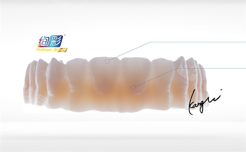 科普到位!爱迪特系列盘点:绚彩/荣耀/EZneer/赛瓷/弹性瓷等优劣势对比/适应人群选择/牙冠修复建议汇总~ - 贝色口腔