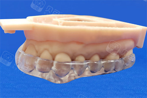 正颌手术咬合板佩戴时间全攻略!咬合板一板戴几周?4~8周比较常见 - 贝色口腔