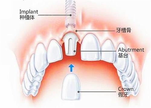 瑞典nobel种植牙哪个型号好？PMC|PCC|Active三种型号对比 - 贝色口腔