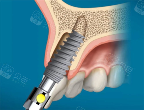 诺贝尔种植牙cc、pcc、pmc哪个好?多角度对比来了!不知道三者怎么选择的速看! - 贝色口腔