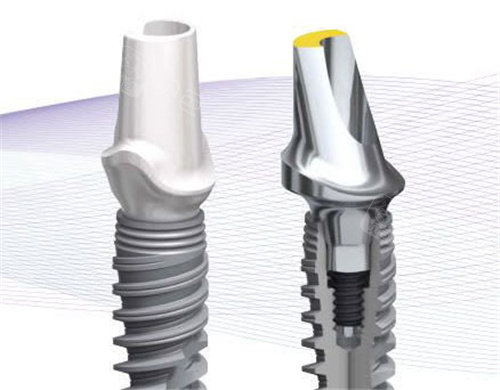 诺贝尔三种植体的区别:设计-材质-特色-价格对比,Active/PCC/PMC哪款更适合你 - 贝色口腔