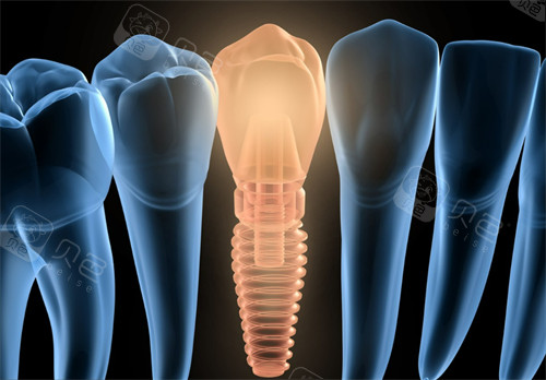 口腔种植技巧：分析士卓曼BLx和BLT价格区别，对比两款植体材质|设计|应用|价格提供选择建议！ - 贝色口腔