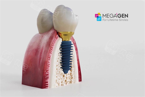 韩国megagen-St全方面解析:进口种植体技术亮点+临床表现实测+如何选择 - 贝色口腔