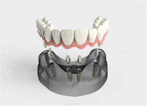 详细解析：士卓曼BLX和BLT有何区别？blx植体强度高微创|blt种植体规格多适应性广泛！ - 贝色口腔